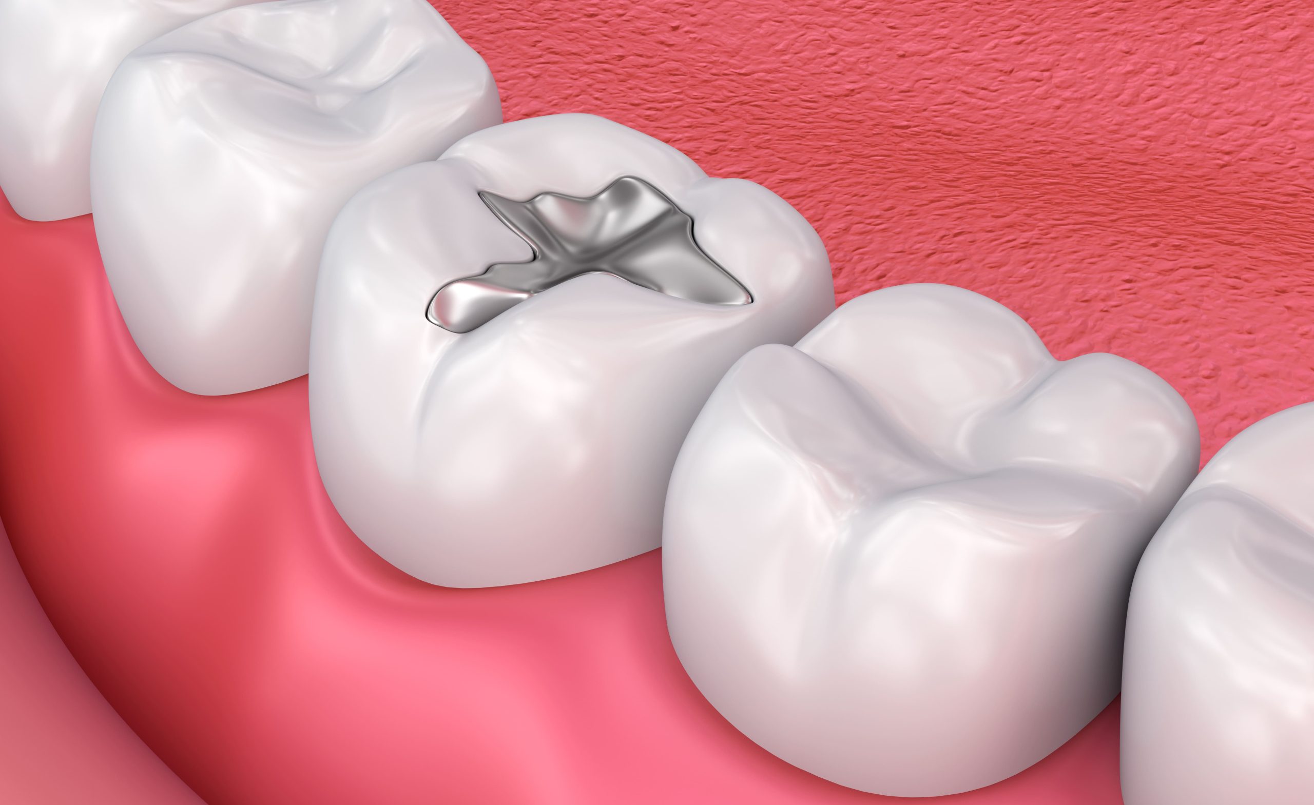 Norwood Tooth Fillings - Norwood Dentistry